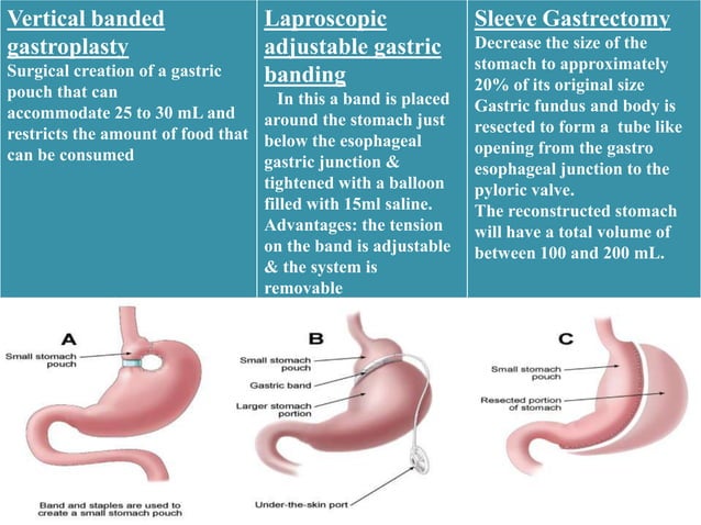 Anesthesia for bariatric surgery | PPTX
