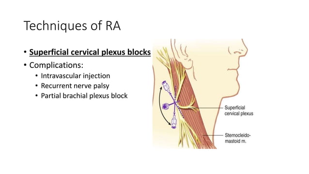 Anesthesia for carotid endarterectomy | PPTX