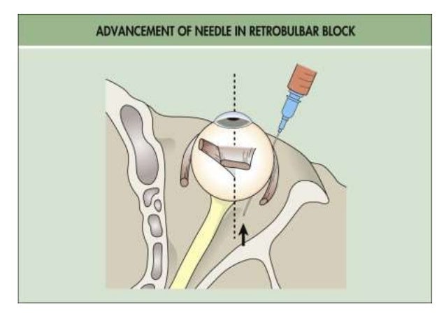 Anesthesia for cataract surgery