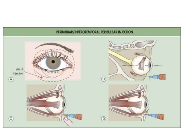 Anesthesia for cataract surgery
