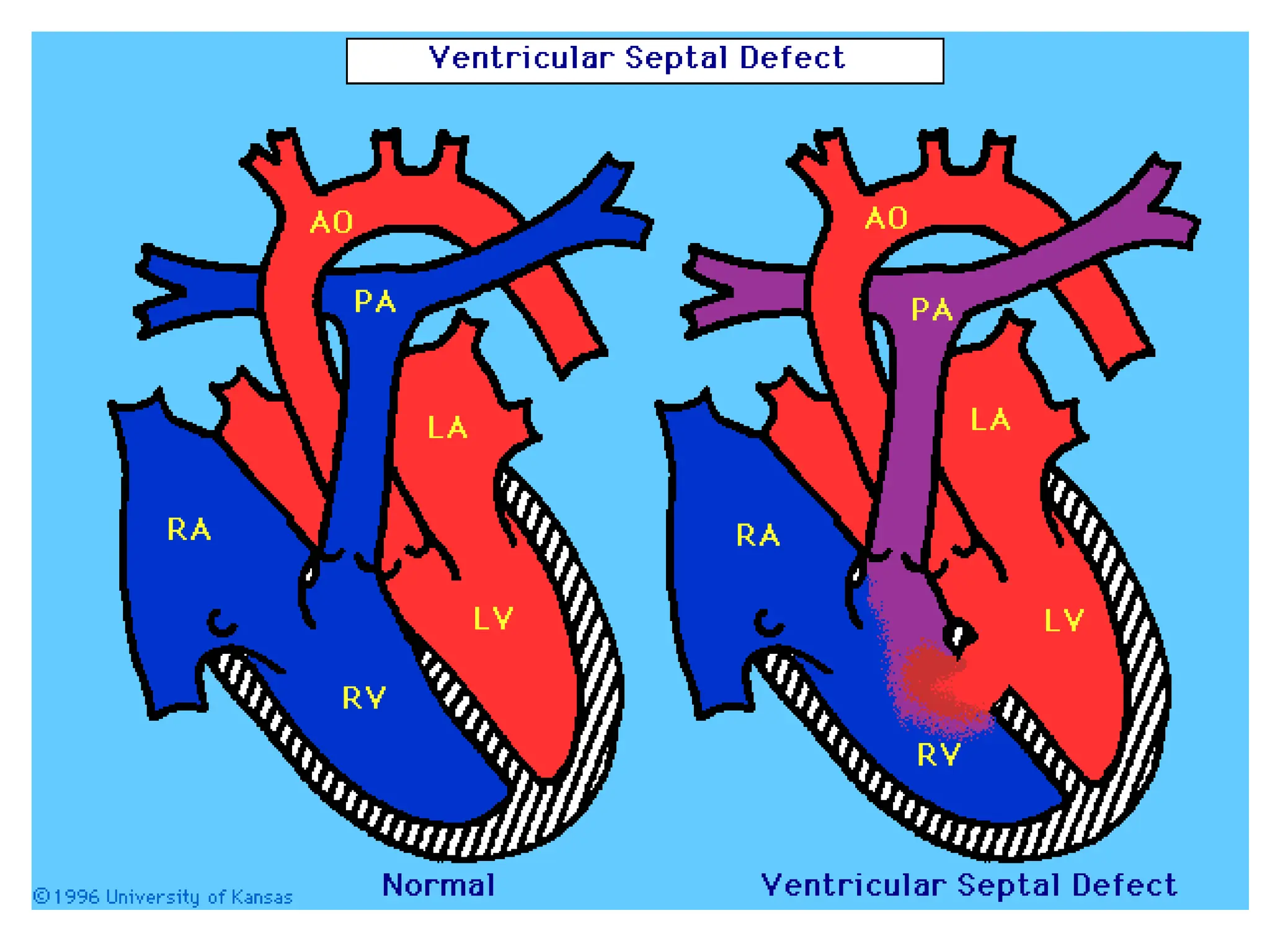 ANESTHESIA FOR CHD.pptx