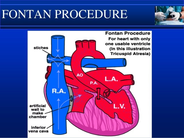Anesthesia for children with Congenital Heart Disease