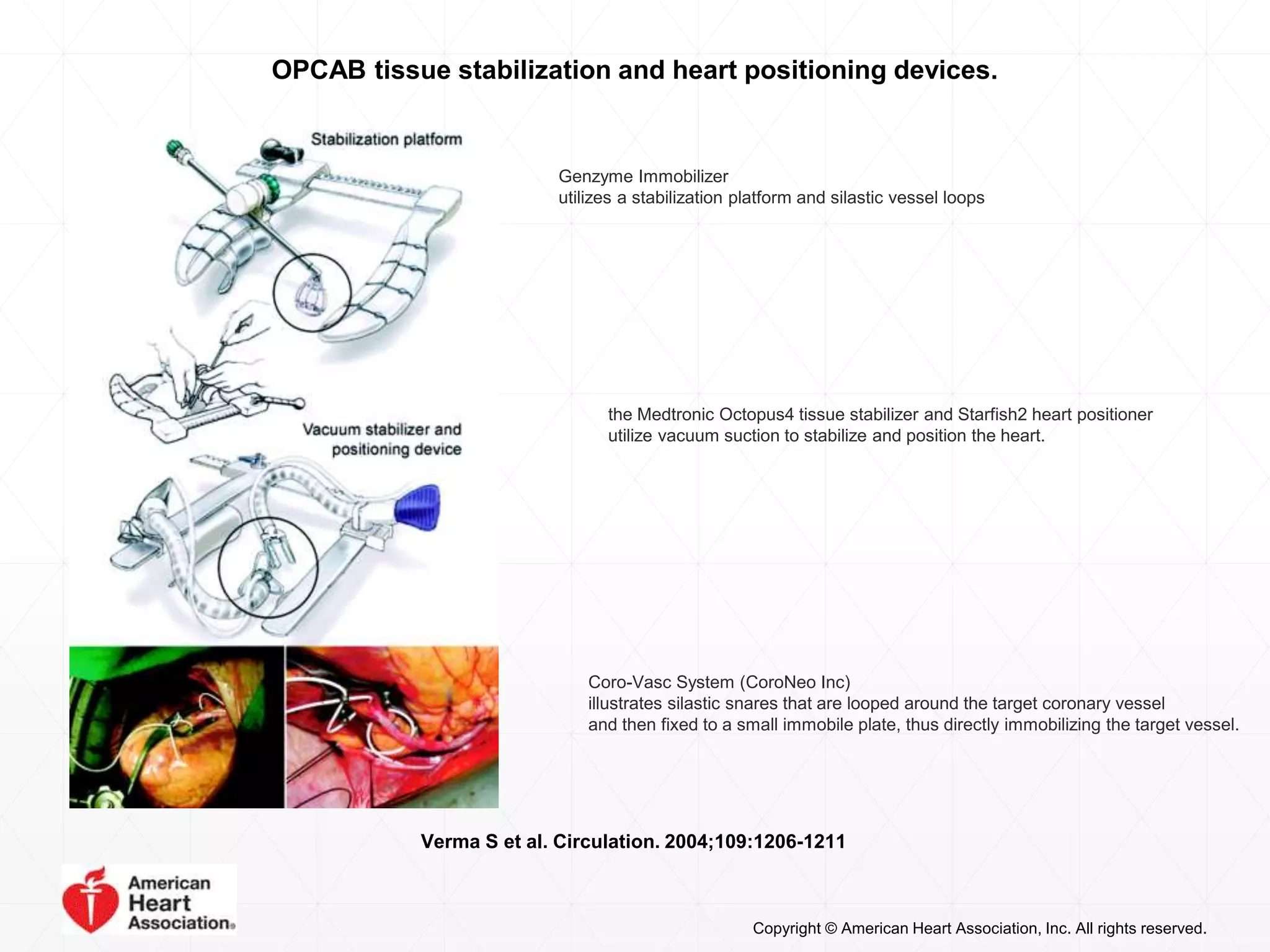 Anesthesia for coronary artery bypass grafting | PPTX
