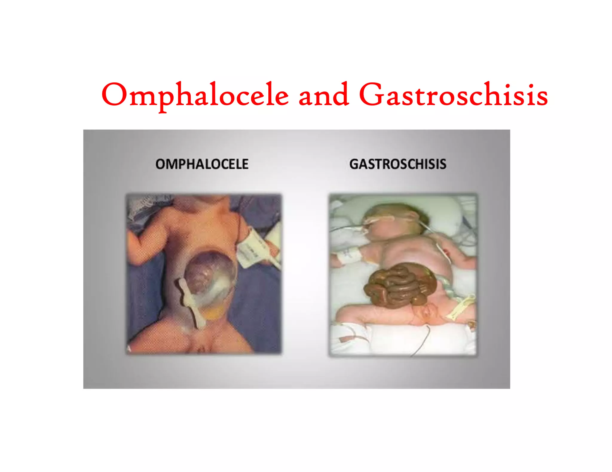 Anesthesia for Neonatal congenital correction surgery.pdf