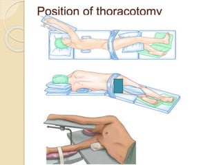 Anesthesia for thoracic surgery (2).pptx