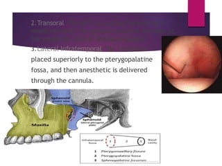 Anesthesia in ENT.pptx