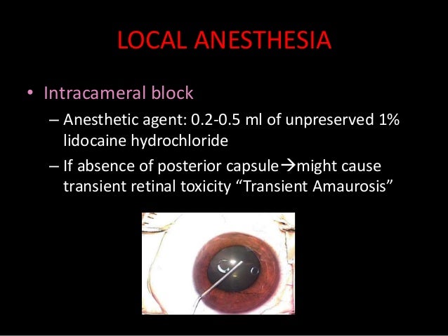 Anesthesia in ophthalmic surgery