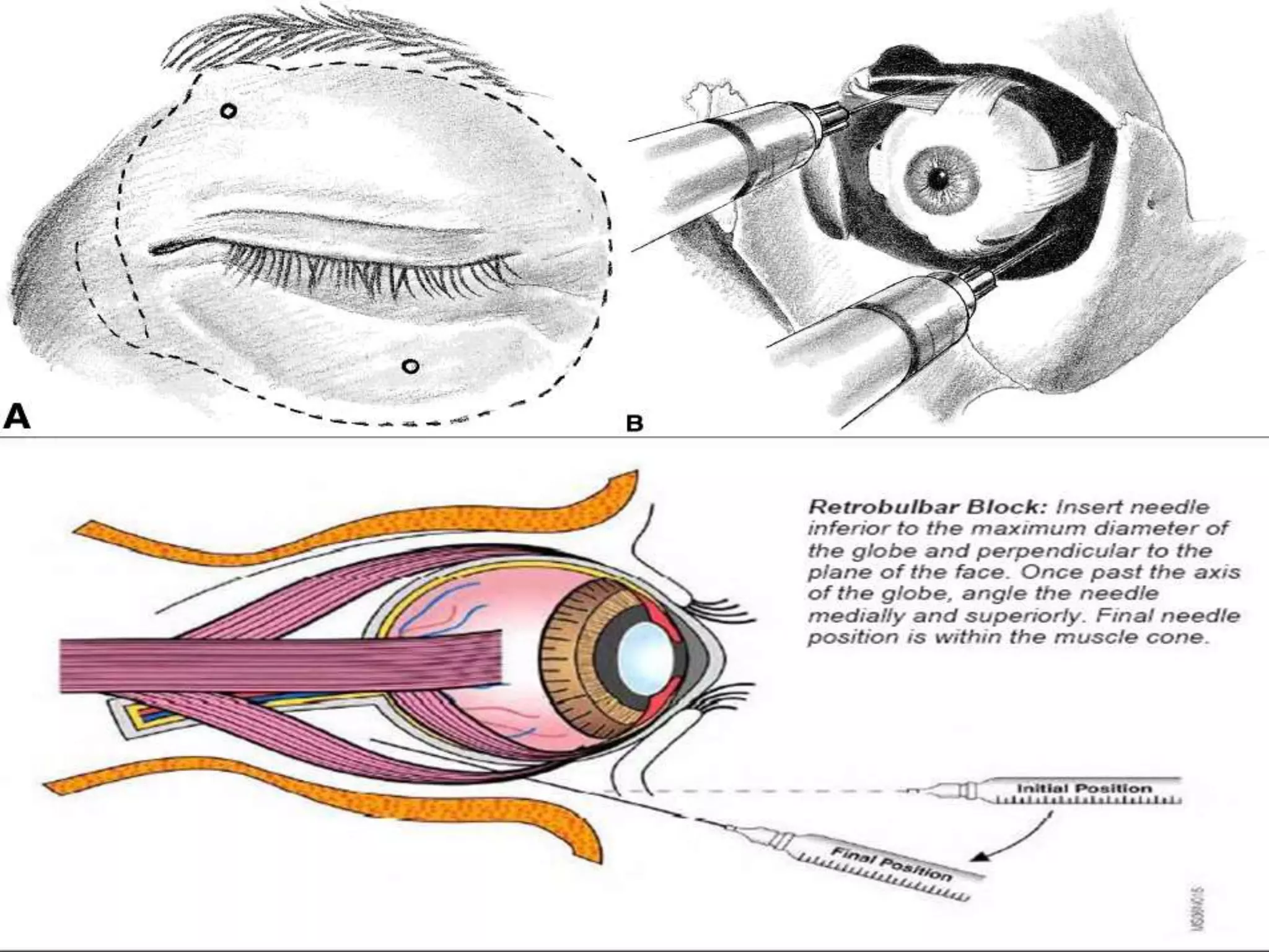 Anesthesia in ophthalmic surgery dr ferdous | PPTX