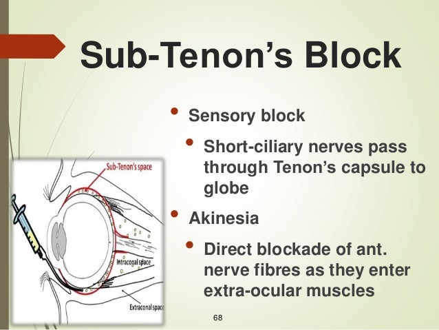 Anesthesia in ophthalmic surgery dr ferdous