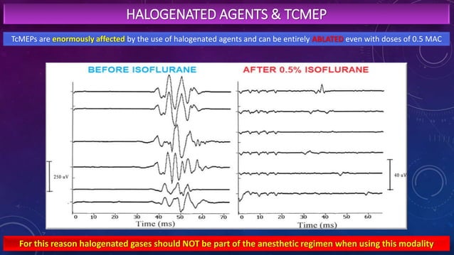Anesthesia and IONM | PPTX
