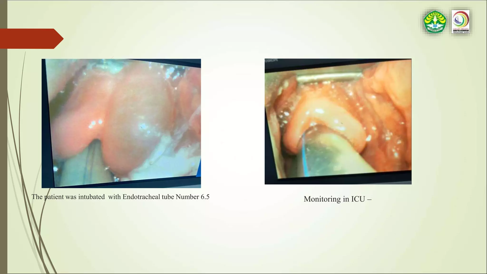 ANESTHESIA MANAGEMENT IN BURN WITH INHALATION TRAUMA - Copy.ppt