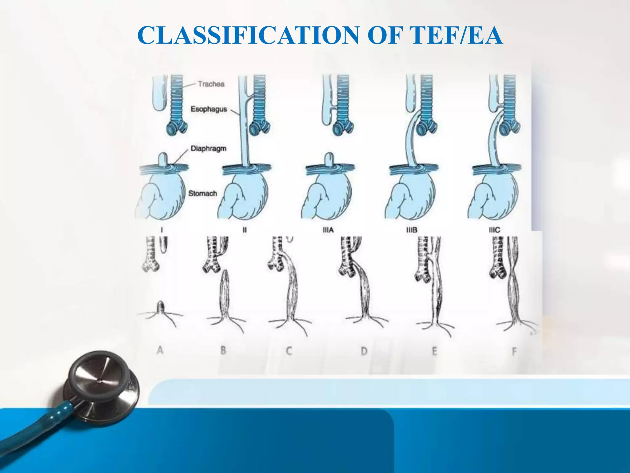 ANESTHETIC MANAGEMENT OF TRACHEOESOPHAGEAL FISTULA by Dr.Sravani ...