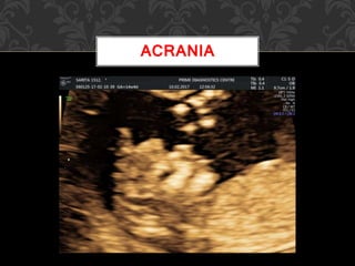 Screening for fetal aneuploidy | PPTX