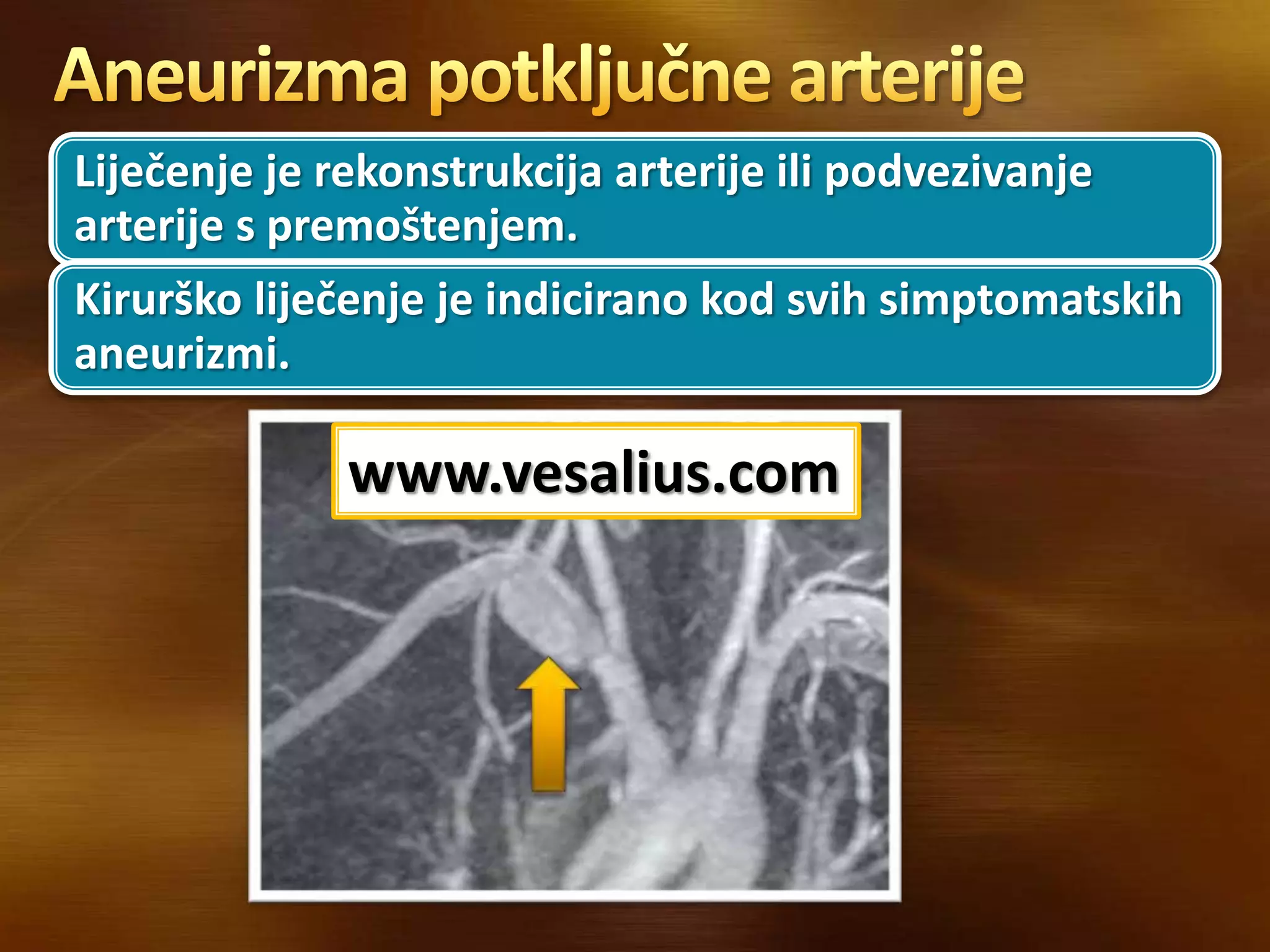 Aneurizme arterija | PPSX