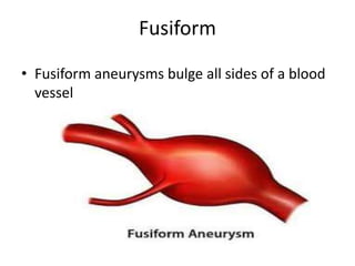 Aneurysm | PPTX | Heart and Cardiovascular Diseases | Diseases and ...