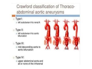 Thoracic Aortic Aneurysm Classification