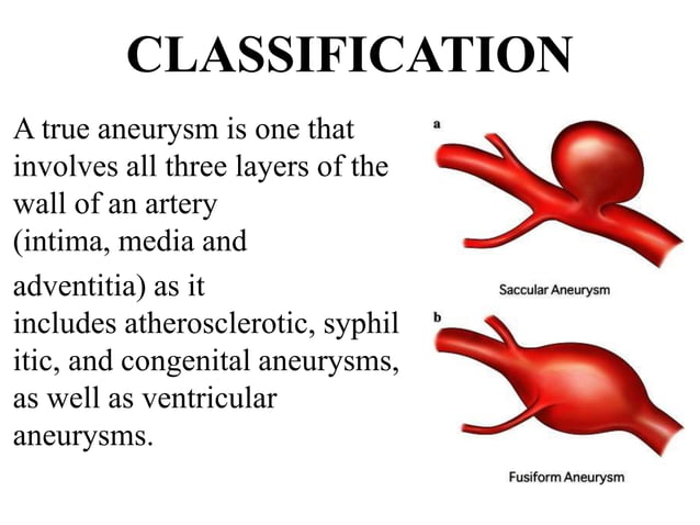 Aneurysm | PPT