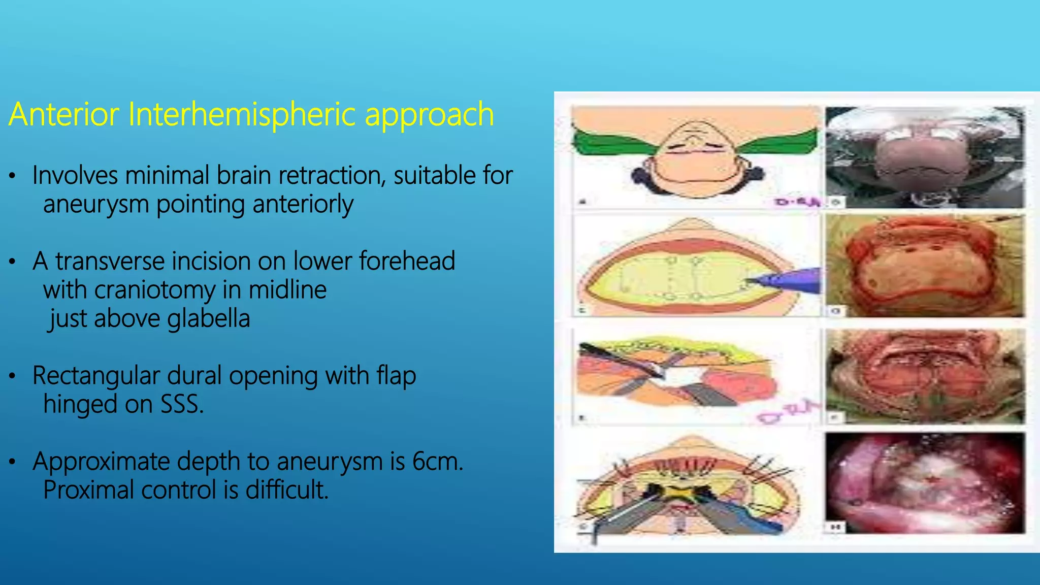 Anterior circulation Aneurysm | PPTX
