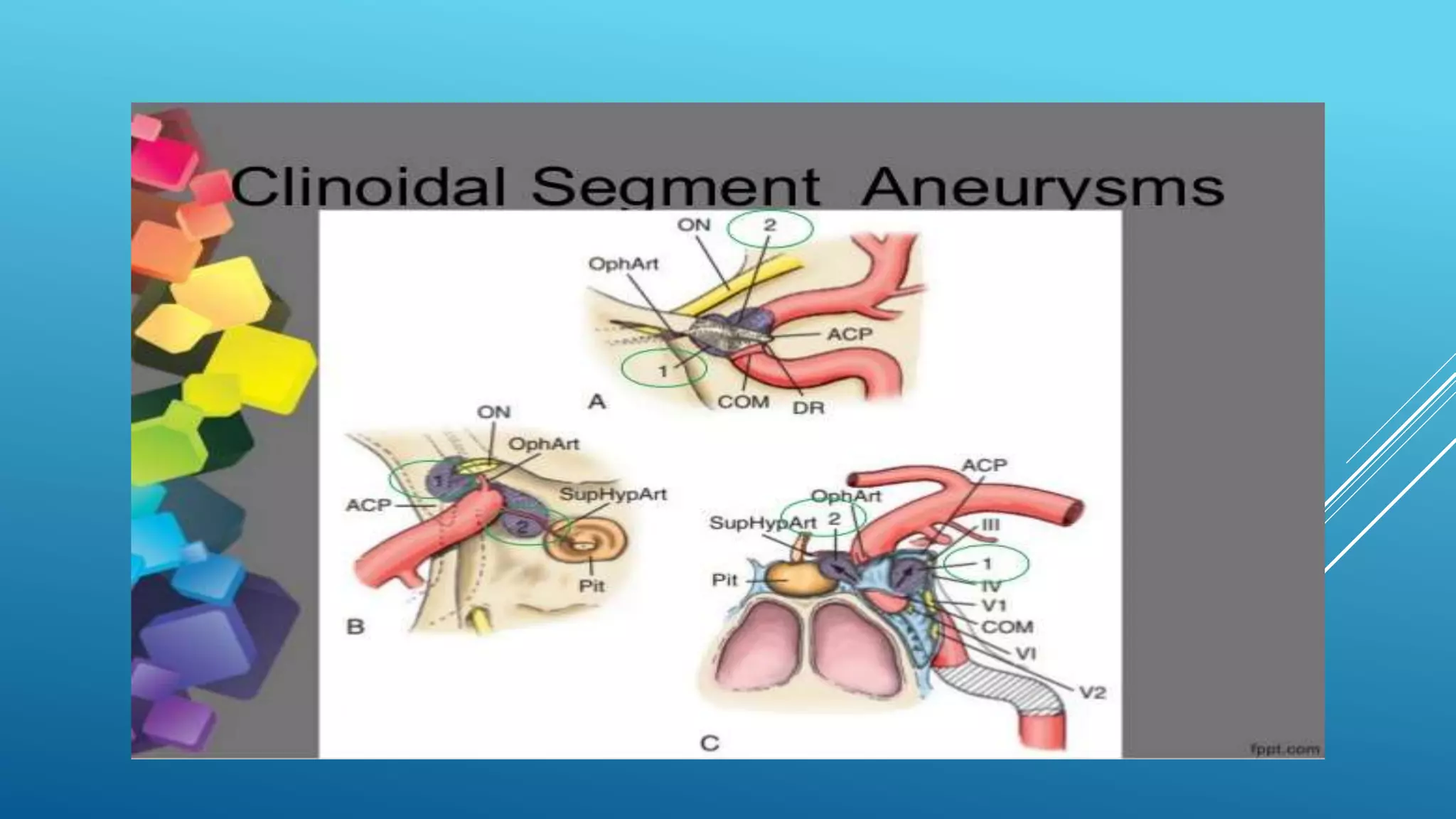 Anterior circulation Aneurysm | PPTX