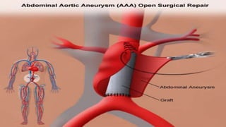 aneurysm-210530112039.pdf