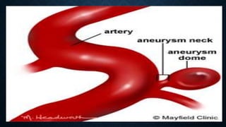 aneurysm-210530112039.pdf