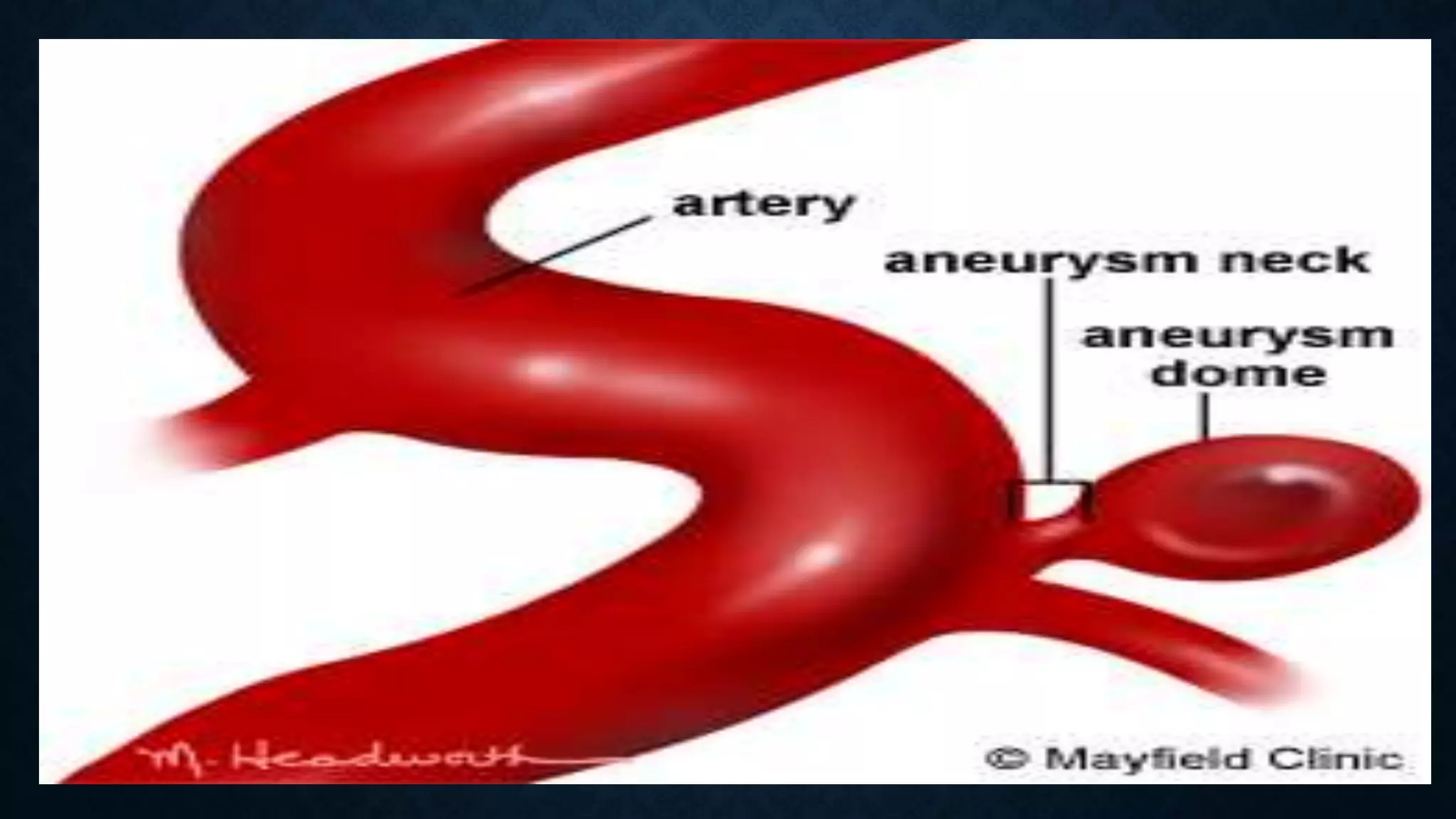 Aneurysm | PPTX