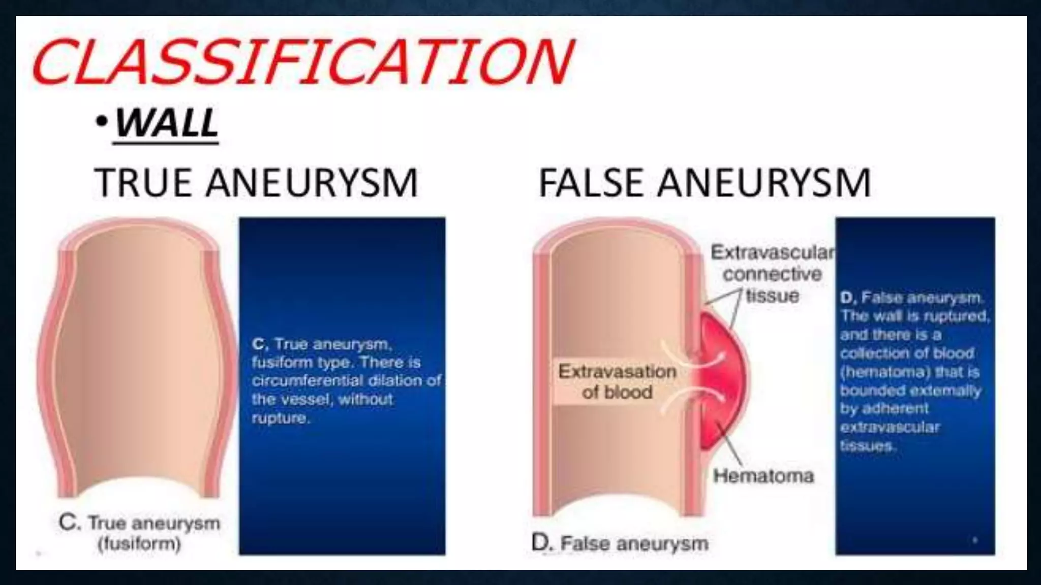 Aneurysm | PPTX