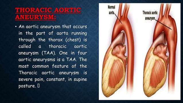 Aneurysm | PPTX | Heart and Cardiovascular Diseases | Diseases and Conditions