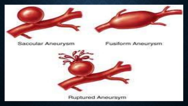 Aneurysm | PPTX | Heart and Cardiovascular Diseases | Diseases and ...