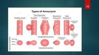 ANEURYSMS , TYPES AND THERE MANAGEMENT.pptx