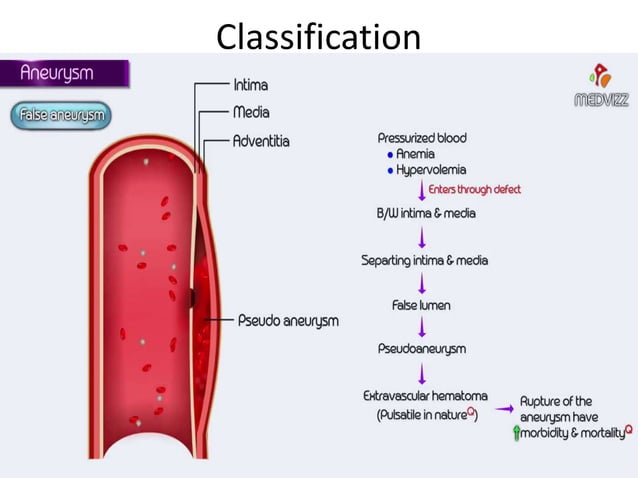 aneurysm pathology pptx from.robbins sss | PPT