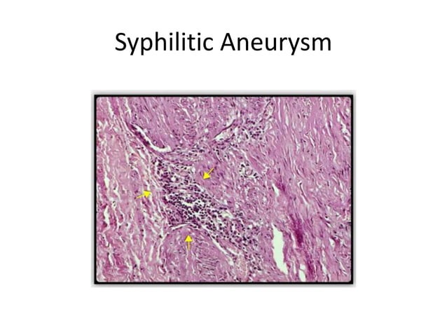 aneurysm pathology pptx from.robbins sss | PPT