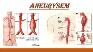 aneurysm.pdf for nursing students for medical surgical nursing students | PPT