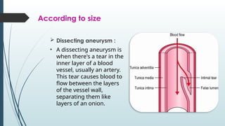 Aneurysm , classification of aneurysm and causes of aortic aneurysm | PPTX