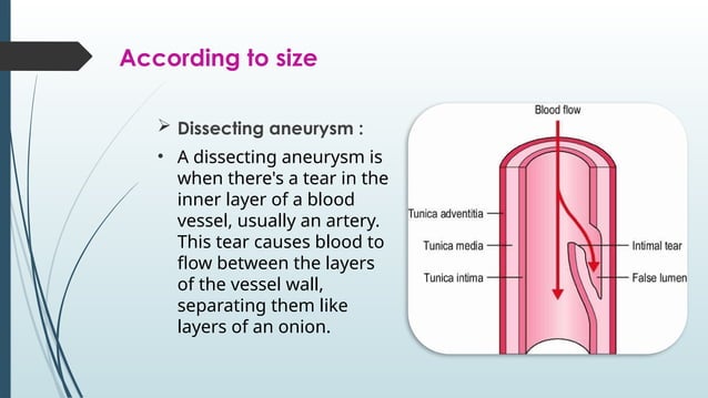 Aneurysm , classification of aneurysm and causes of aortic aneurysm | PPT