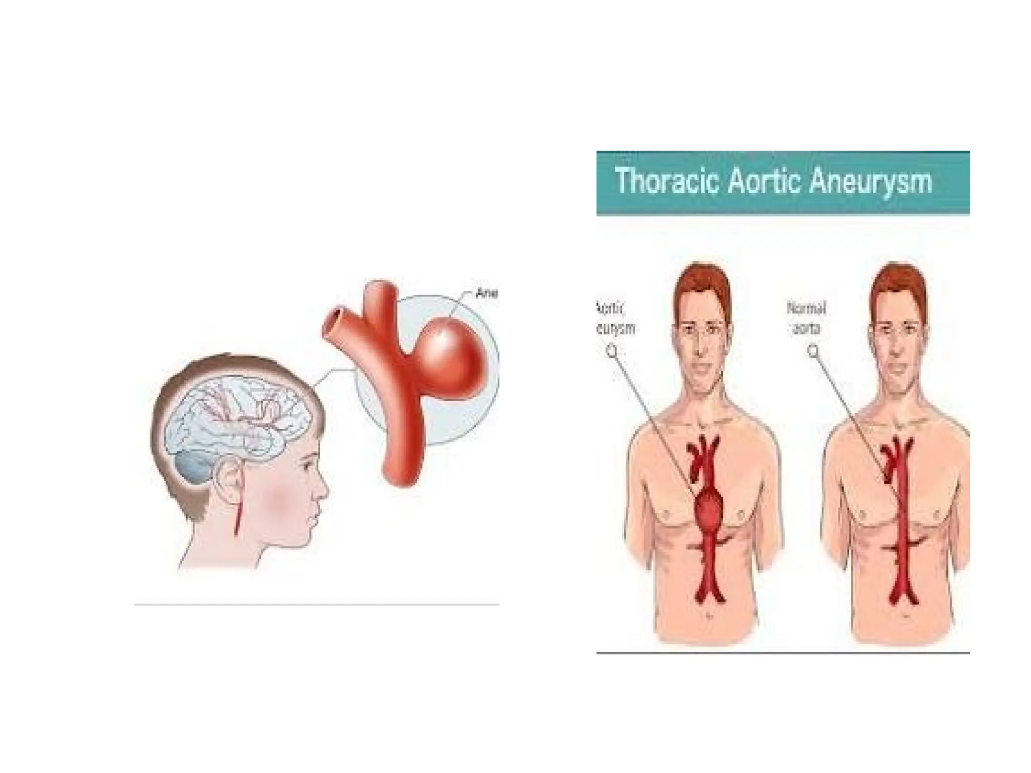 Aneurysm.pptx its medical and nursing management | PPTX