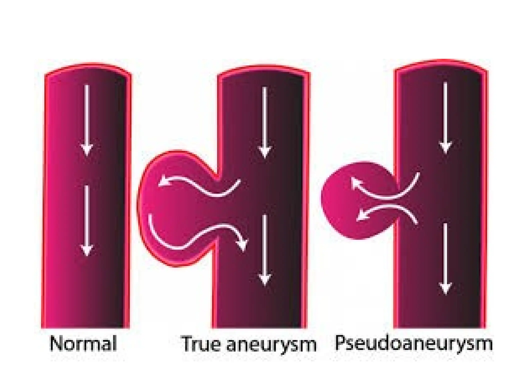 Aneurysm.pptx its medical and nursing management | PPTX