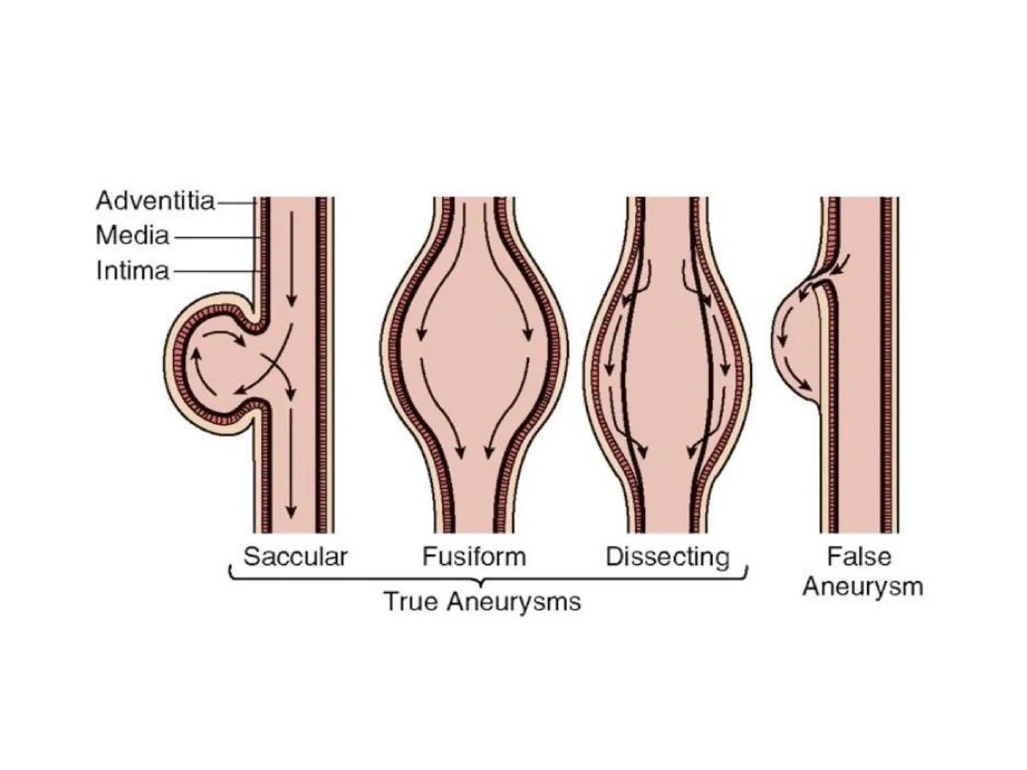 Aneurysm.pptx its medical and nursing management | PPTX