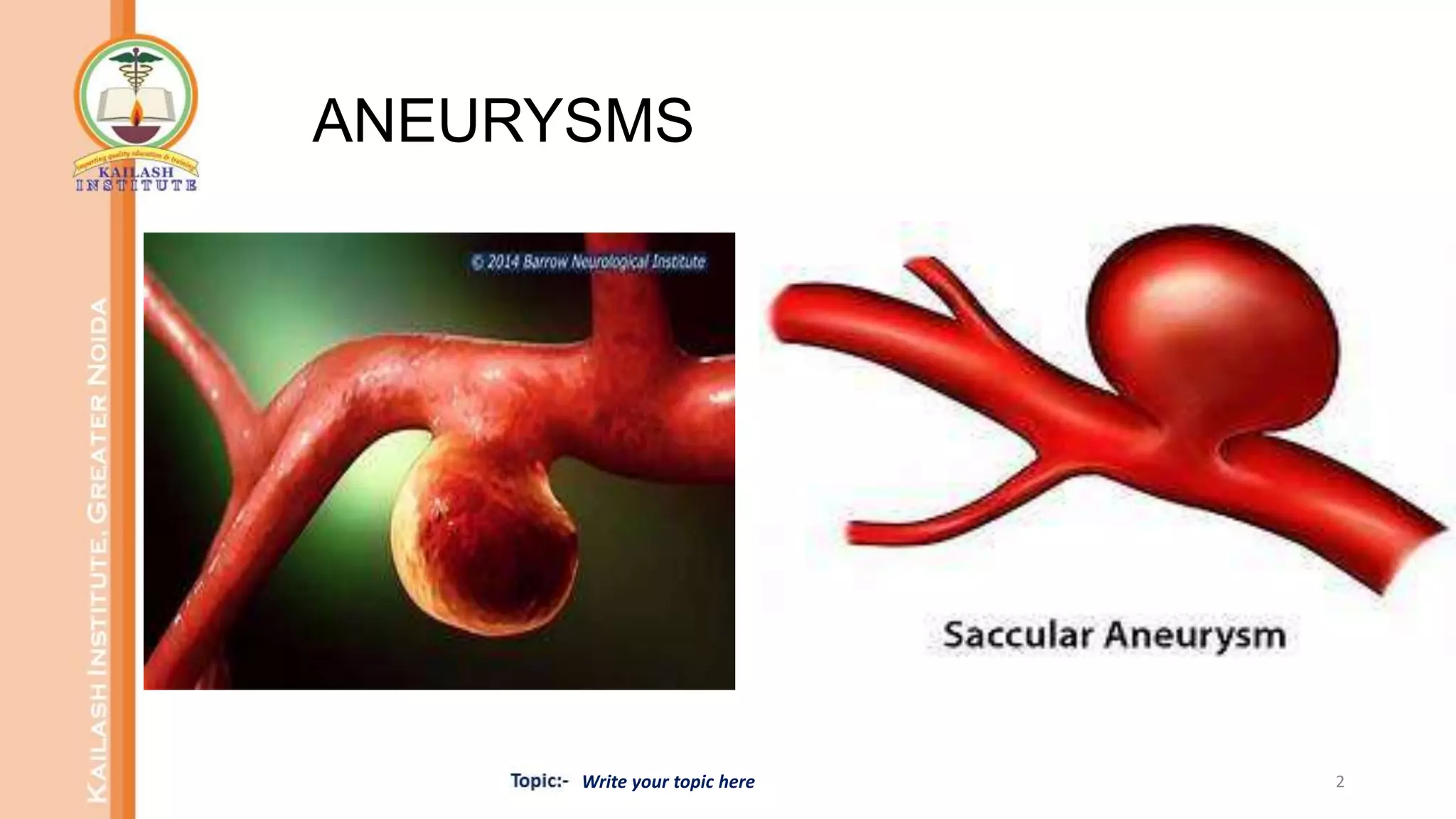 ANEURYSM | PPT | Free Download