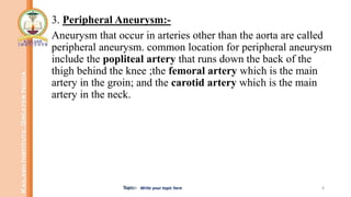 ANEURYSM | PPT