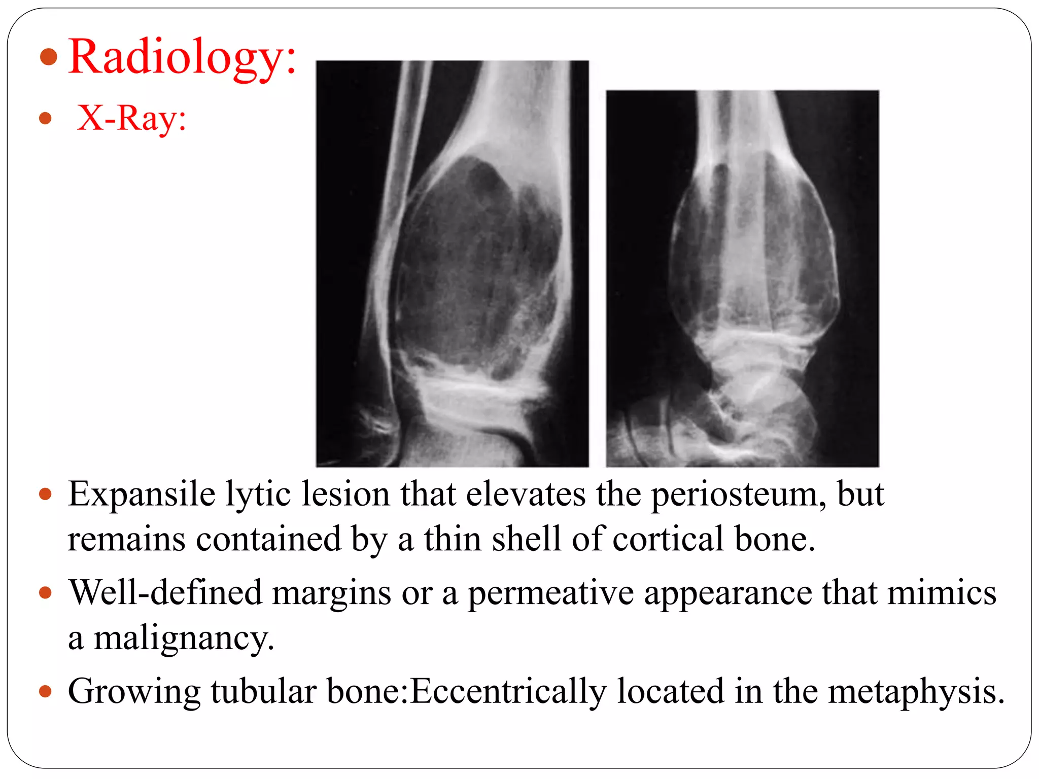 Traumatic Bone Cyst Ppt