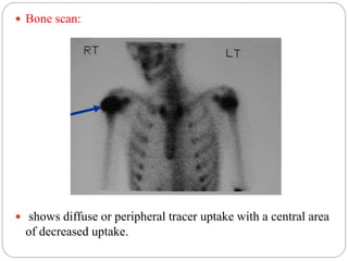 Aneurysmal bone cyst | PPTX
