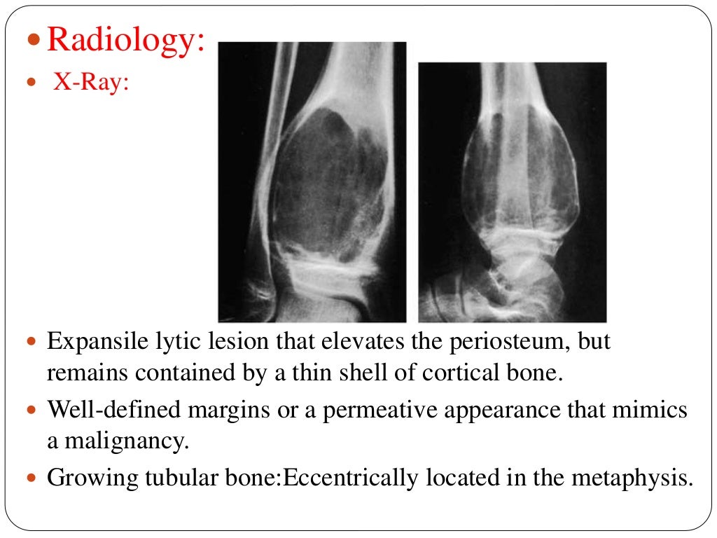 Aneurysmal bone cyst