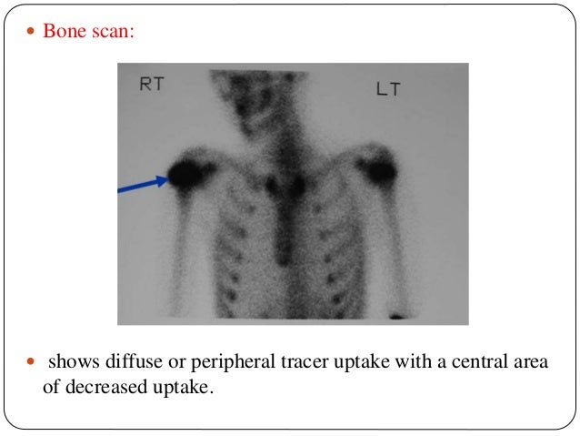 Aneurysmal Bone Cyst