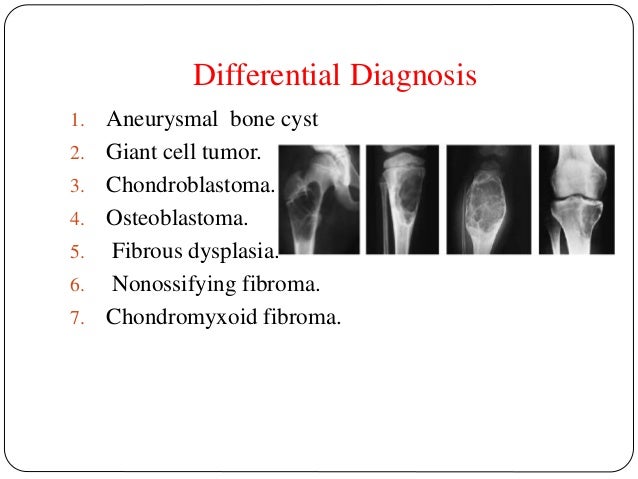 Aneurysmal bone cyst