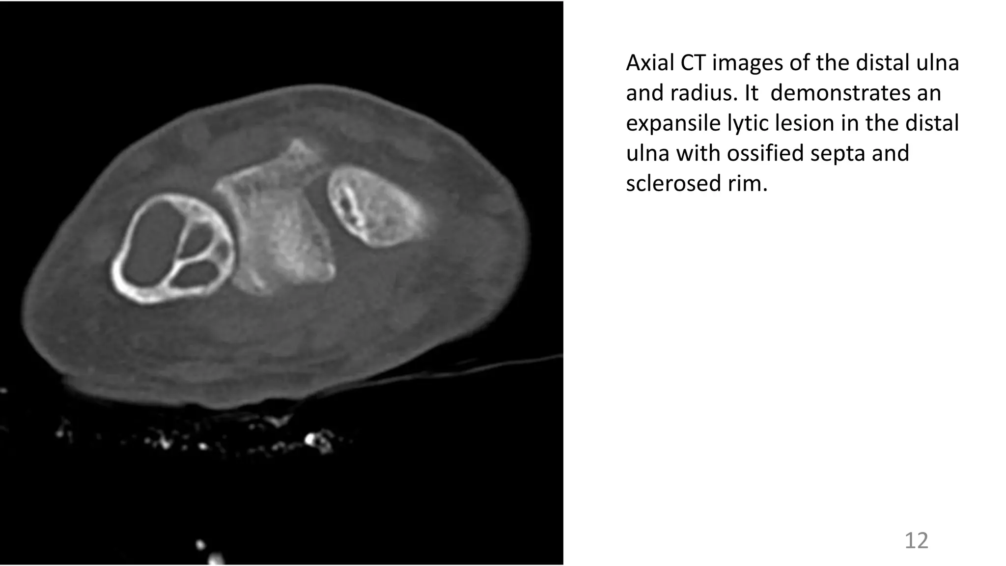 Aneurysmal Bone Cyst.pptx