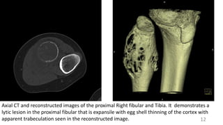Aneurysmal Bone Cyst.pptx