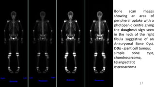Aneurysmal Bone Cyst.pptx
