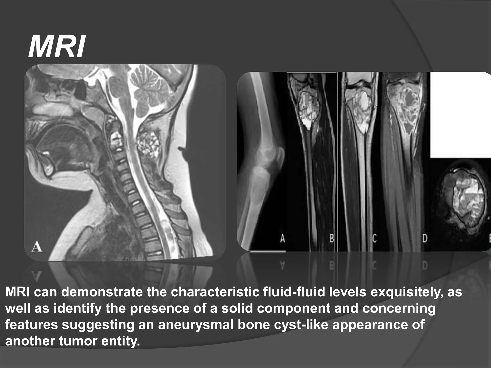 Aneurysmal bone cyst.pptx