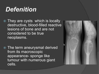 Aneurysmal bone cyst.pptx